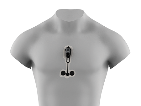 Eclipse Mini on torso | Spacelabs Healthcare